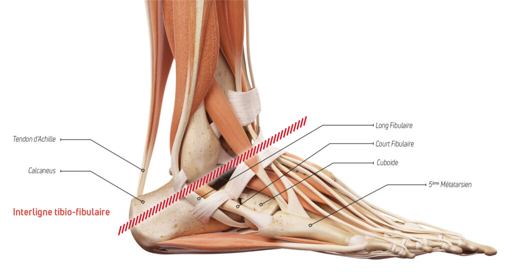 COMMENT SOULAGER LA TENDINOPATHIE ACHILLEENNE ? - Enovis France