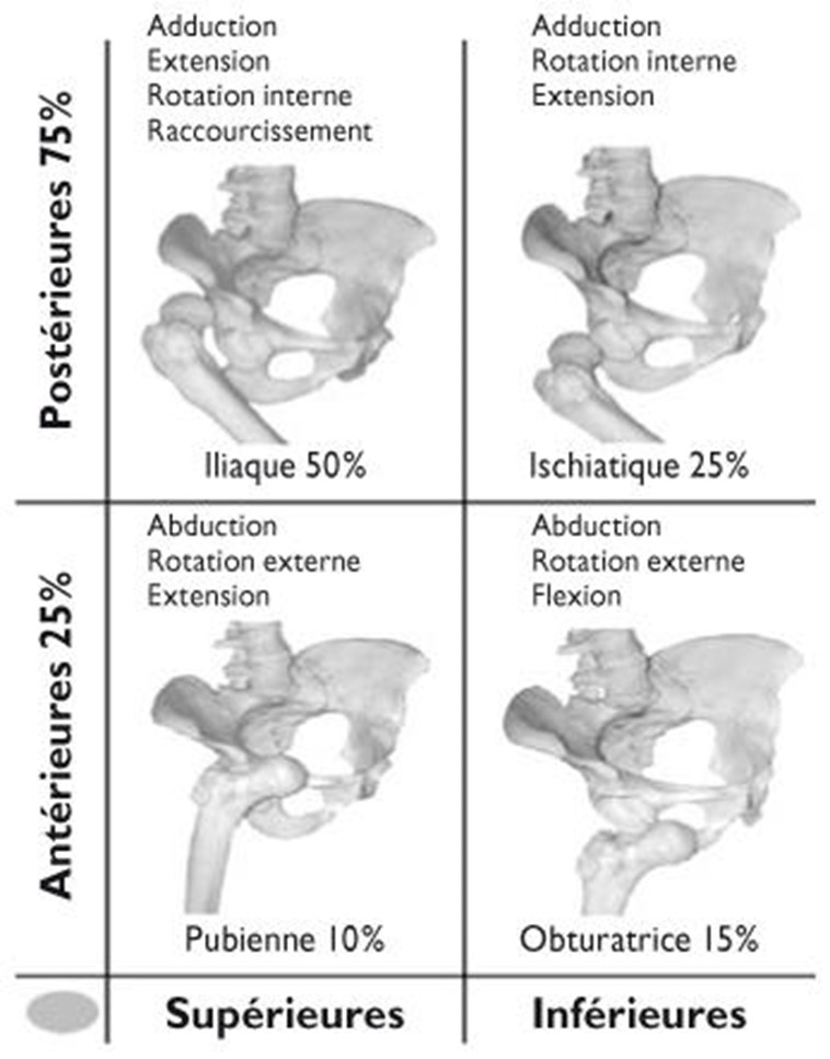 LUXATION DE LA HANCHE - Enovis France
